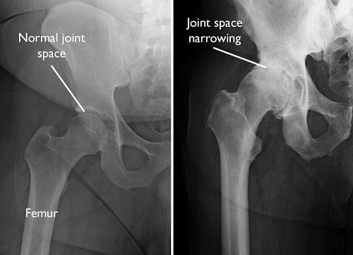 LABRAL TEAR OF HIP - Dr bala vardhan reddy